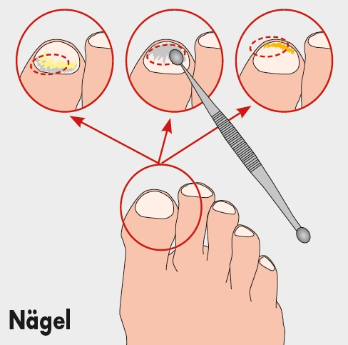 Probenahme für molekularbiologischen Pilznachweis