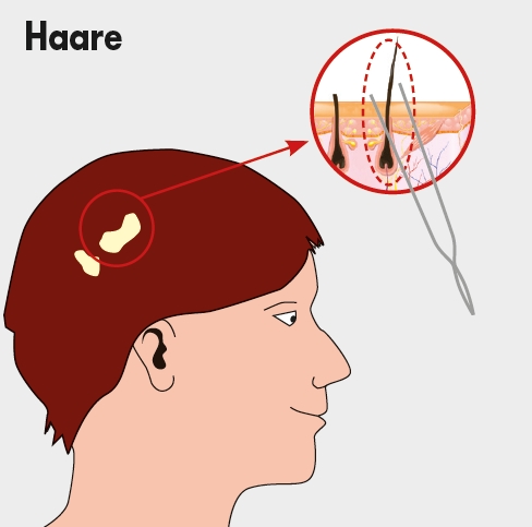 Probenahme für molekularbiologischen Pilznachweis