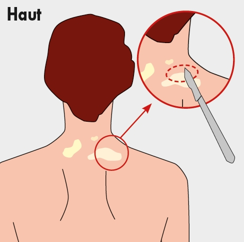 Probenahme für molekularbiologischen Pilznachweis